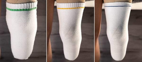 Manage Residual Limb Volume Changes Using ALPS Prosthetic Socks