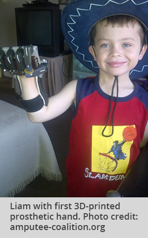 Part 1: A Brief History of 3D Printing in the Orthotic & Prosthetic ...